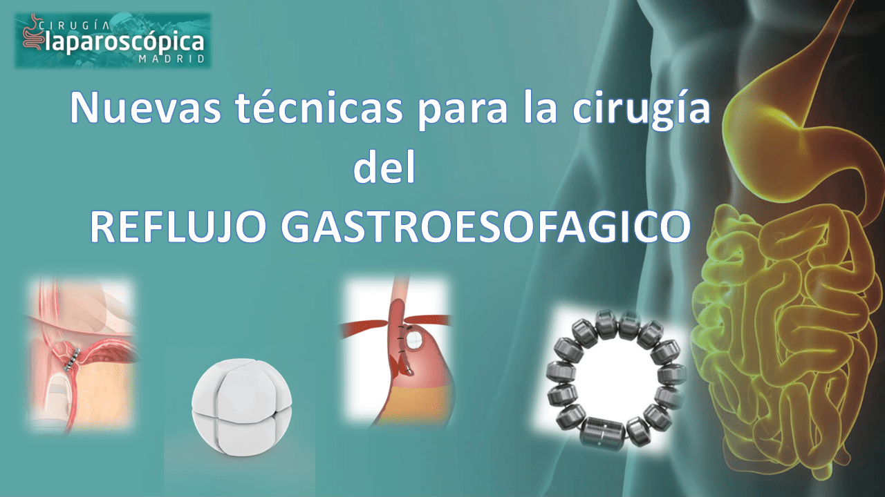 NUEVO VIDEO EN TOP DOCTORS: REFLUXSTOP y LINX, nuevas técnicas para la ...