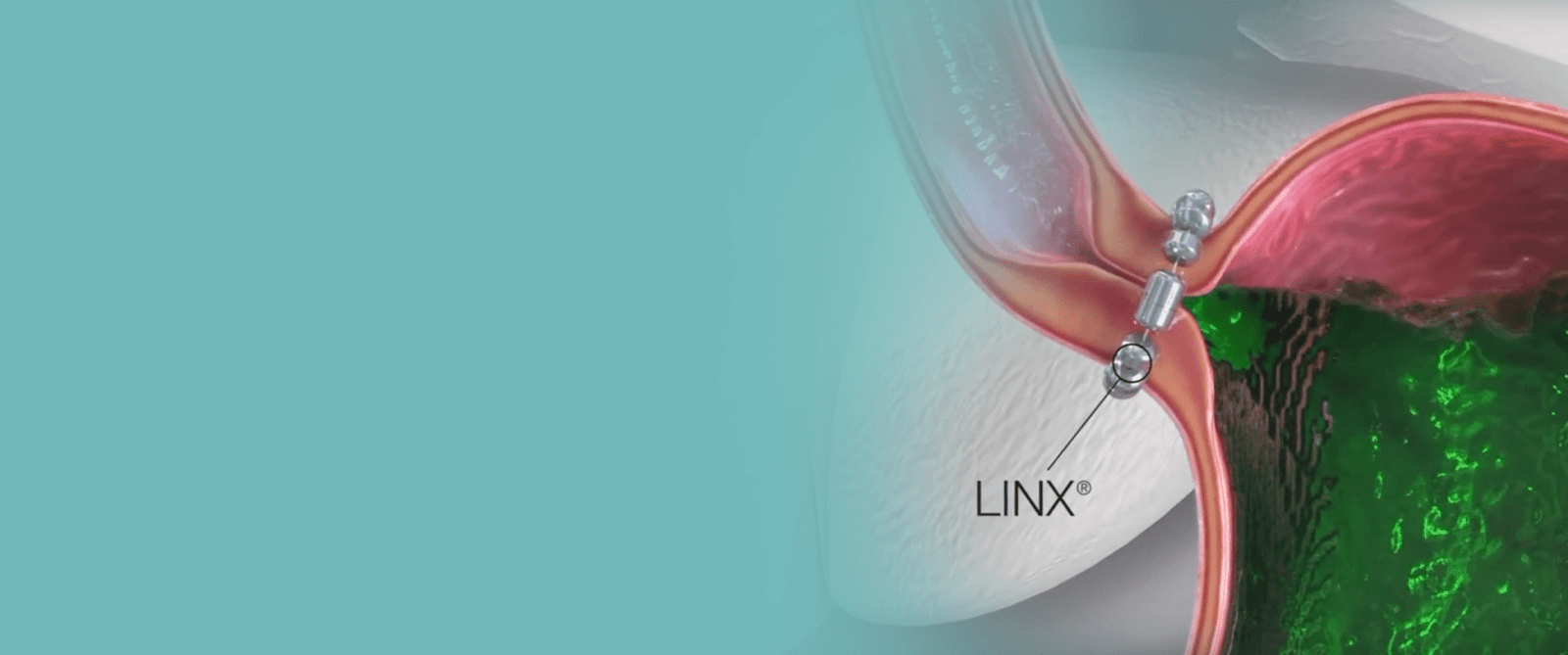 Cirugía Laparoscópica Madrid | Expertos en cirugía mínimamente invasiva